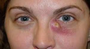 Nasolacrimal Duct Obstruction (NLDO) | At Eye Clinic