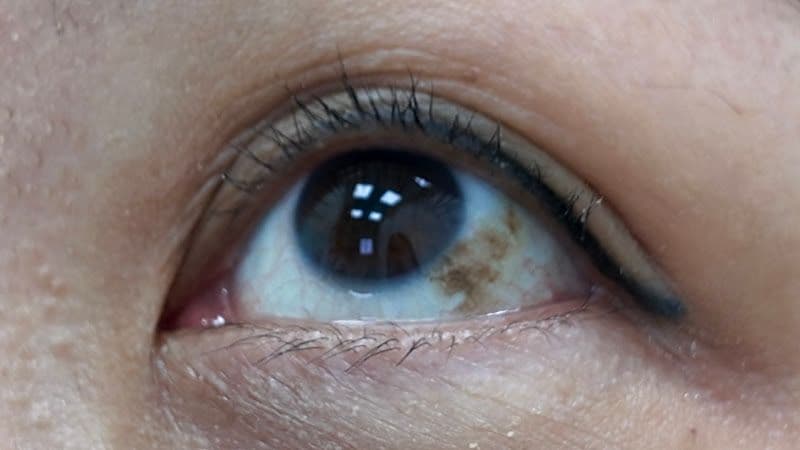 Pigmentation on the White of the Eye: Unattractive but Concerning? | At ...